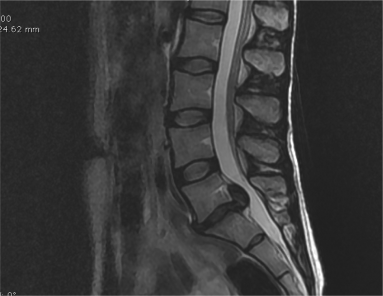 columna lumbar - Neurocirugía Barcelona