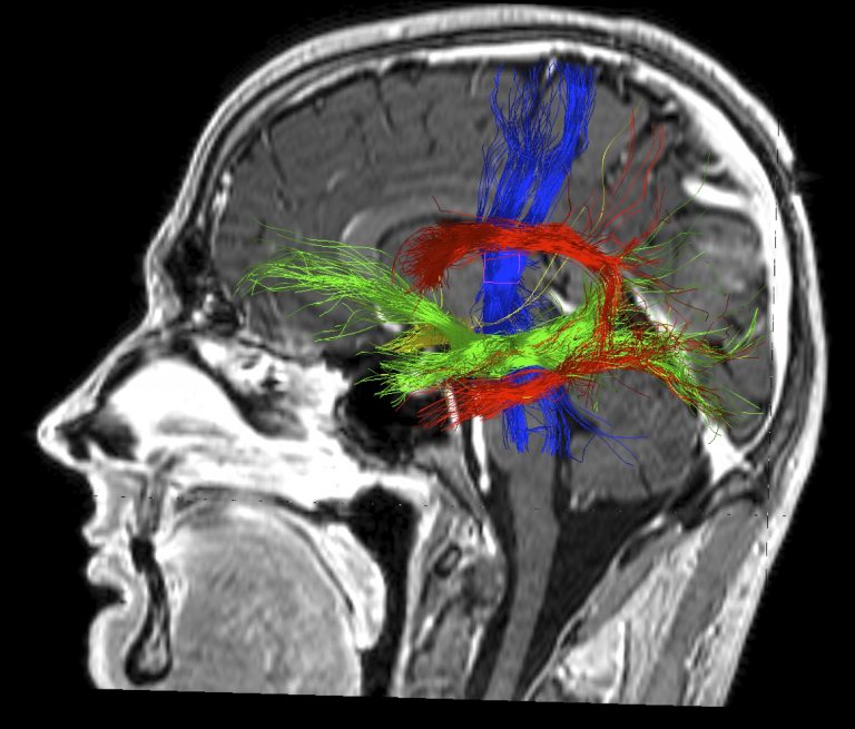Neuronavigation - Neurocirugía Barcelona